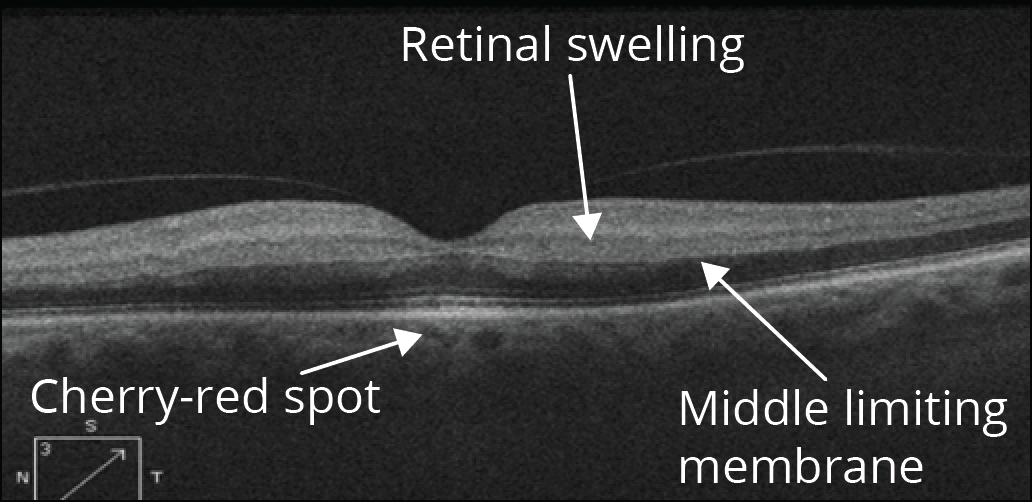 The OCT Reading Test: We are marking your test…